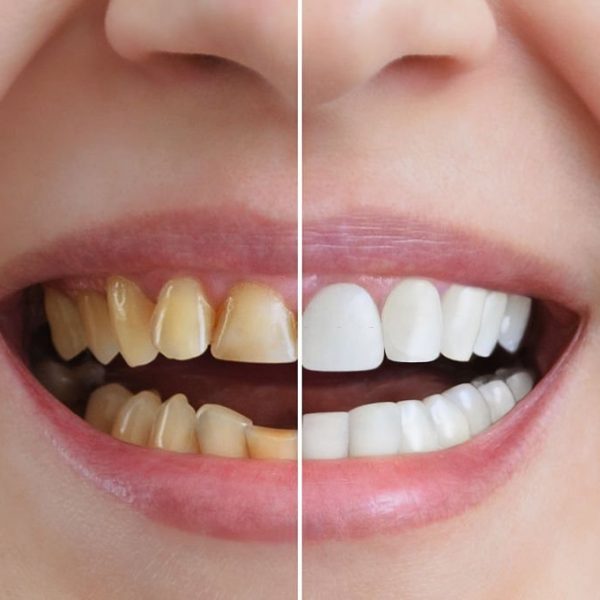 Before And After: Real-Life Cosmetic Dentistry Transformations