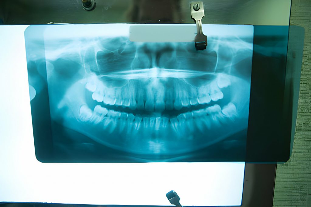 Different Types of X-Rays by Dental Summerville, SC